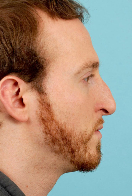 Functional Rhinoplasty Philadelphia | Nose Surgery Wayne