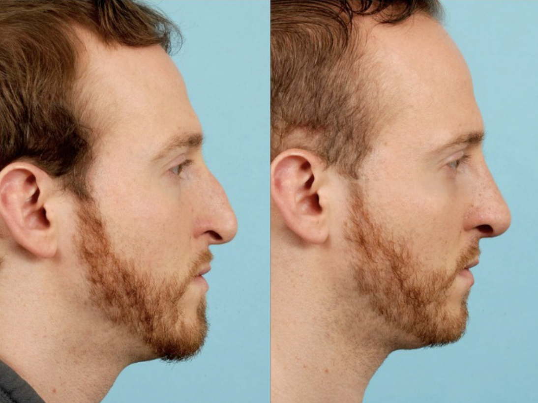 Tip Plasty (Nose Tip Rhinoplasty) Philadelphia
